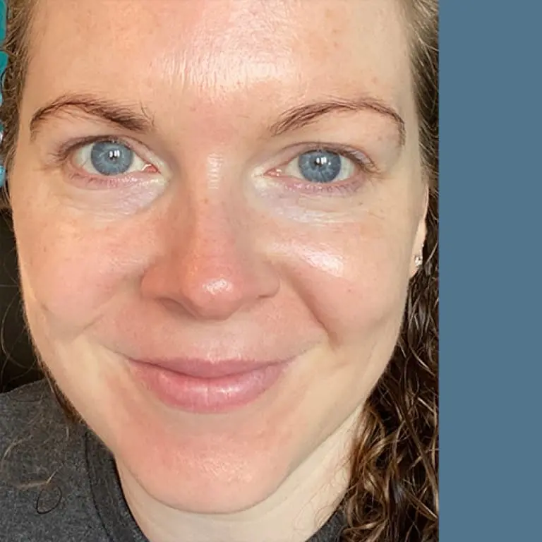 Skin + Me - Personalised skin treatment to treat acne and skin-ageing.