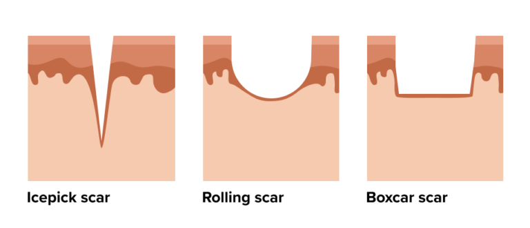 Acne scarring – what is it and how to treat it? – Skin + Me