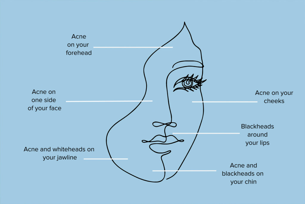 Acne Face Mapping Your Guide To What s Causing Your Spots The Dose Acne Face Mapping Your Guide To What s Causing Your Spots The Dose